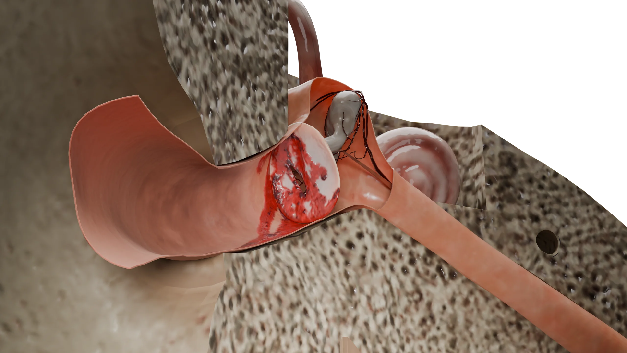 Middle and inner ear injuries: classification, symptoms, treatment